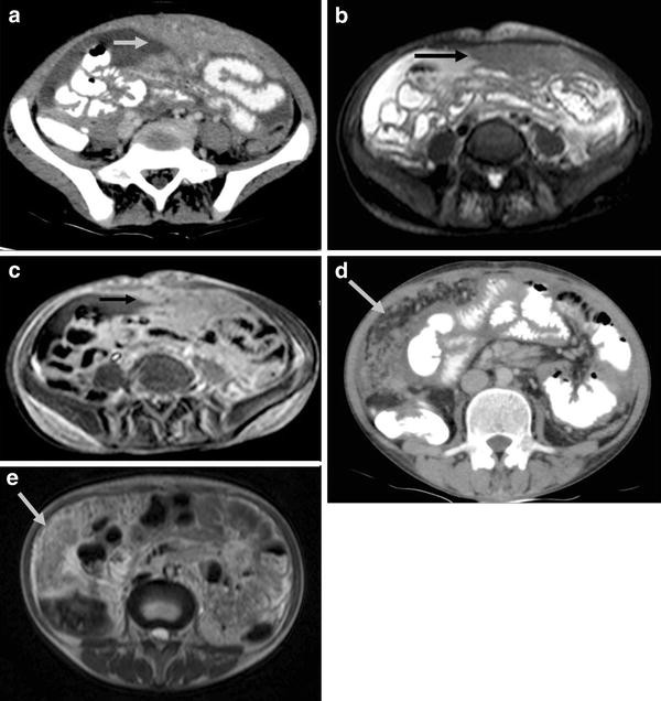 Role of CT and MRI in Abdominal Tuberculosis | SpringerLink