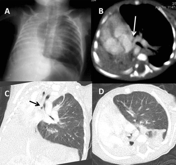 Congenital Malformations and Developmental Anomalies of the Lung ...