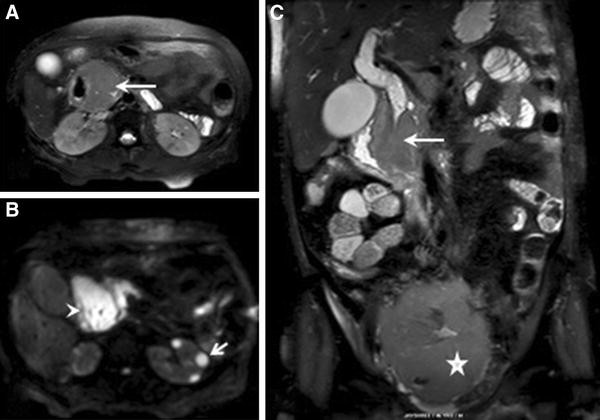 Role of CT and MRCP in Evaluation of Biliary Tract Obstruction ...