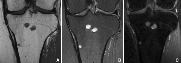 Magnetic Resonance Imaging in Pediatric Bone Tumors | SpringerLink