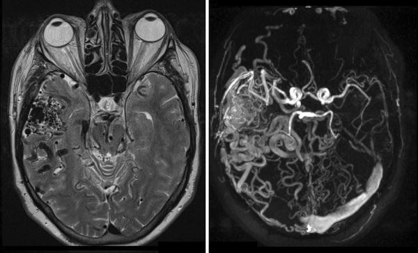 Pulsatile Tinnitus: Differential Diagnosis and Radiological Work-Up ...