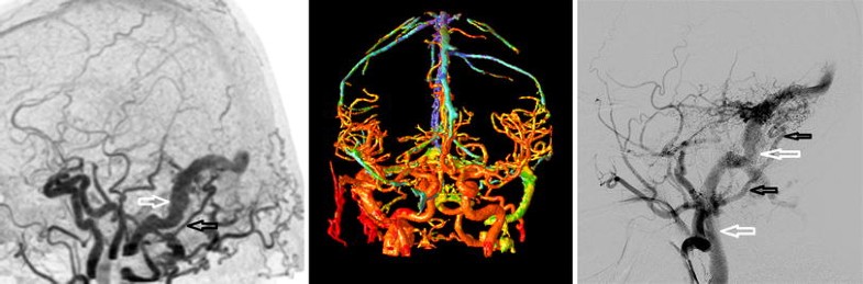 Pulsatile Tinnitus: Differential Diagnosis and Radiological Work-Up ...