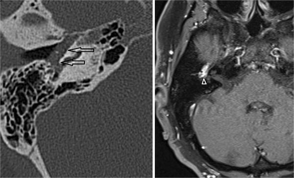 Pulsatile Tinnitus: Differential Diagnosis and Radiological Work-Up ...