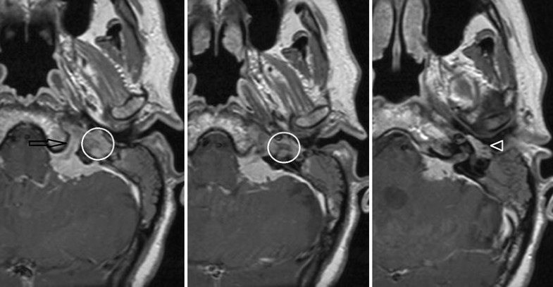 Pulsatile Tinnitus: Differential Diagnosis and Radiological Work-Up ...