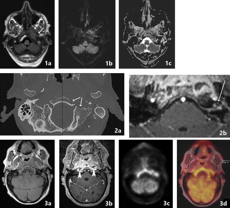 Advanced Imaging Techniques in Skull Base Osteomyelitis Due to ...
