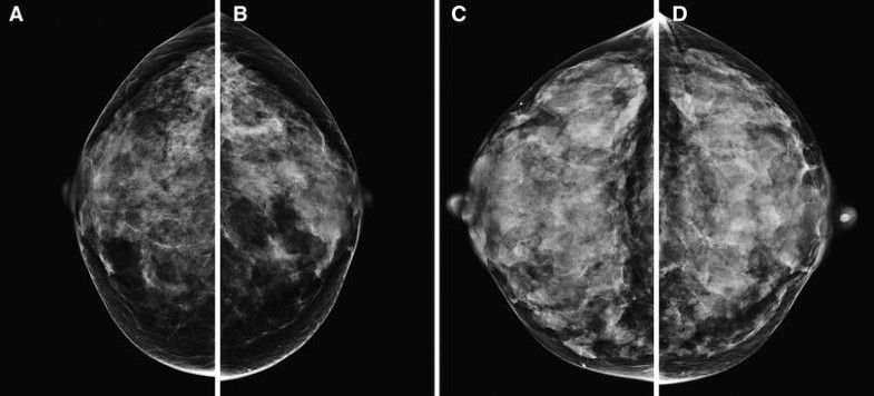Imaging the Breast in Pregnant or Lactating Women | SpringerLink