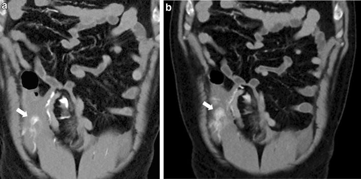 Blunt Injury of the Bowel and Mesentery | SpringerLink
