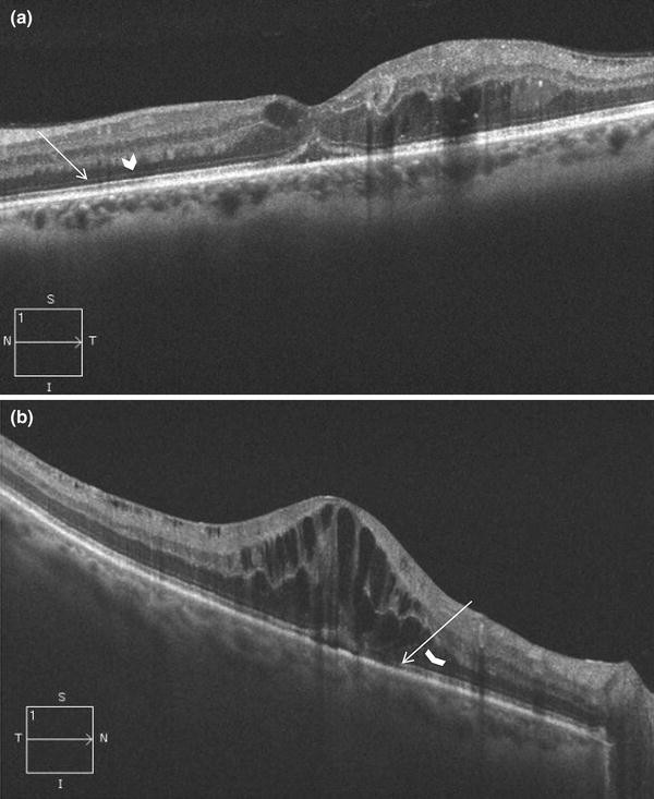 OCT in the Management of Diabetic Macular Edema | SpringerLink