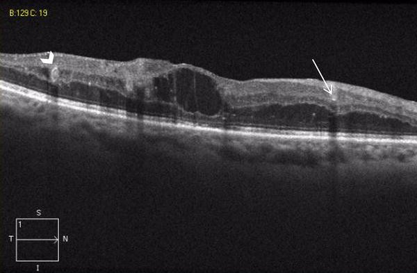 OCT in the Management of Diabetic Macular Edema | SpringerLink