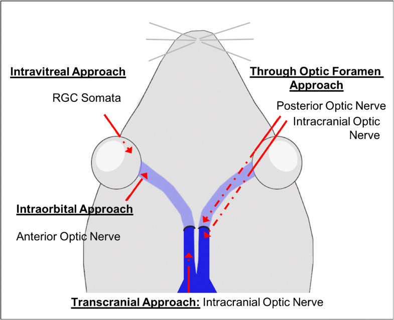 Optic Nerve Regeneration: Considerations on Treatment of Acute Optic Neuropathy and End-Stage ...