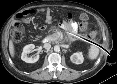 Video-Assisted Retroperitoneal Debridement (VARD) of Infected ...