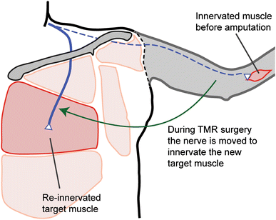 Prosthetic Myoelectric Control Strategies: A Clinical Perspective ...