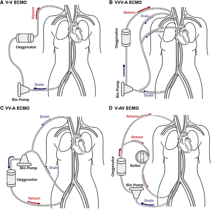 Development and Clinical Use of an Artificial Lung | SpringerLink