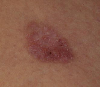 Diagnosis and Treatment of Lichen Sclerosus | SpringerLink