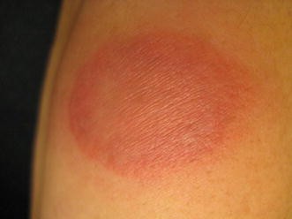 Skin Signs of Rheumatoid Arthritis and its Therapy-Induced Cutaneous ...