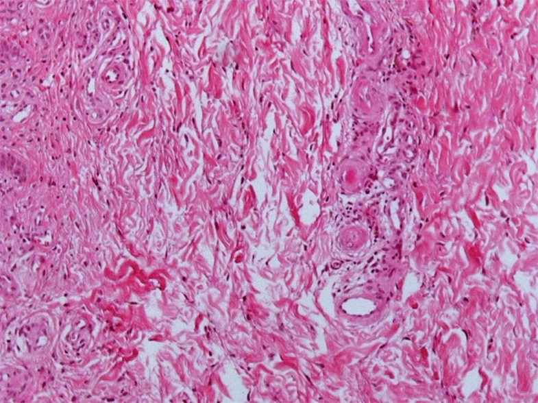 An Update on Calciphylaxis | SpringerLink