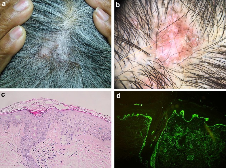 Hair and Scalp Changes in Cutaneous and Systemic Lupus Erythematosus ...