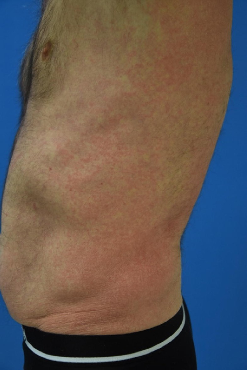 Toxic Side Effects of Targeted Therapies and Immunotherapies Affecting ...