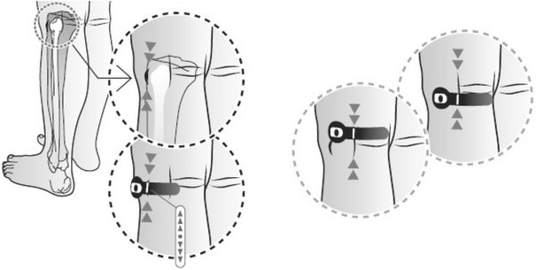 The geko™ Electro-Stimulation Device for Venous Thromboembolism ...