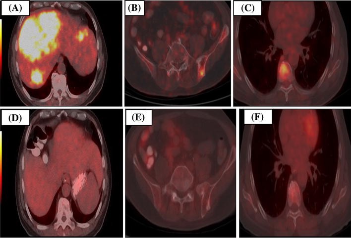PET/CT in patients with liver lesions of different nature | SpringerLink