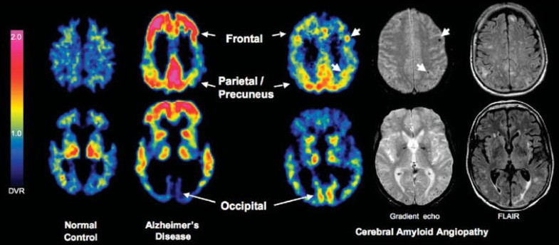 Amyloid PET imaging: applications beyond Alzheimer’s disease | SpringerLink