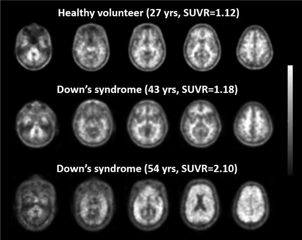 Beta-amyloid imaging with florbetaben | SpringerLink