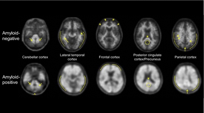 Beta-amyloid imaging with florbetaben | SpringerLink