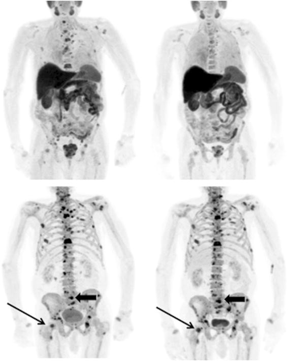 Bone imaging in prostate cancer: the evolving roles of nuclear medicine ...