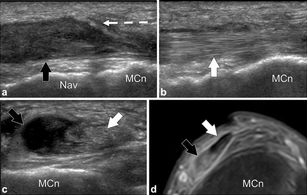 Ultrasound of tibialis anterior muscle and tendon: anatomy, technique ...