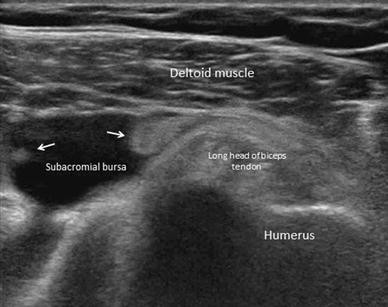 Prevalence of subacromial-subdeltoid bursitis in shoulder pain: an ...