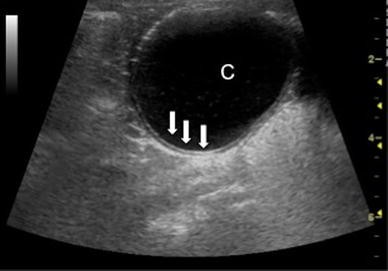 Ultrasound evaluation of the enteric duplication cyst: the gut ...