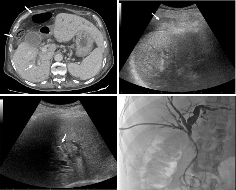 Safety and effectiveness of ultrasound-guided percutaneous transhepatic ...