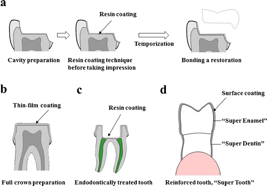 Resin Coating Technique for Protection of Pulp and Increasing Bonding ...