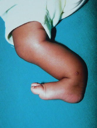 Prenatal Sonographic Features and Postnatal Outcome of Congenital ...