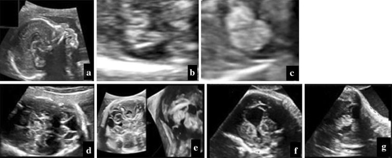 The Midline Sagittal View of Fetal Brain: Moving from 3D to 2D ...
