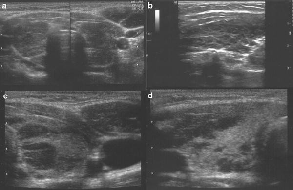 Ultrasound variants of autoimmune thyroiditis in children and ...