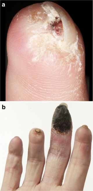 Management of Raynaud’s Phenomenon and Digital Ulcers | SpringerLink