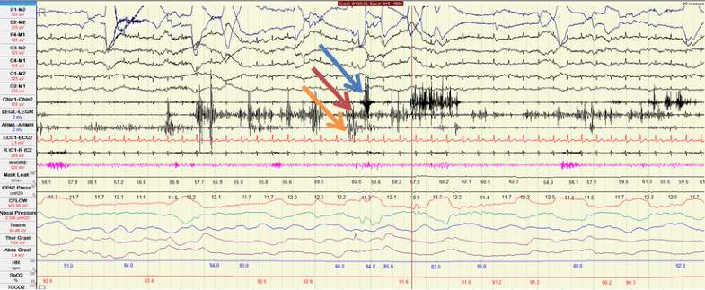 Rapid Eye Movement Sleep Behavior Disorder: Overview and Current ...