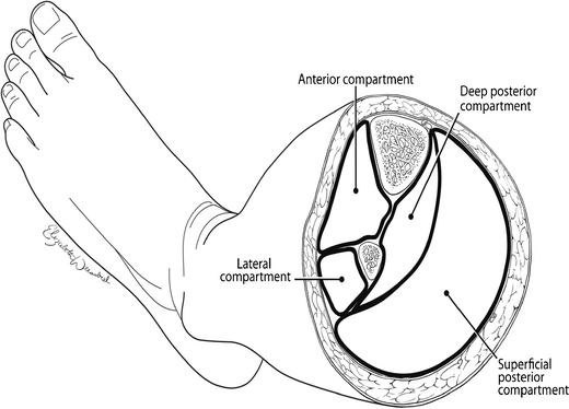Lower Extremity Fasciotomy: Indications and Technique | SpringerLink