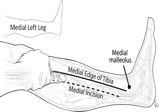 Lower Extremity Fasciotomy: Indications and Technique | SpringerLink