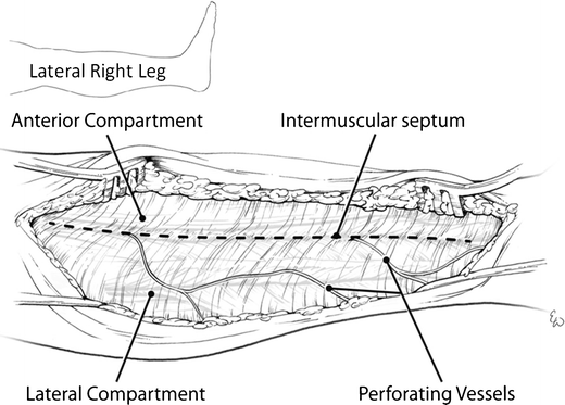 Lower Extremity Fasciotomy: Indications and Technique | SpringerLink