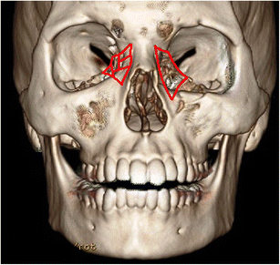 The Acute Management of Facial Fractures | SpringerLink