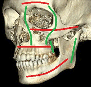The Acute Management of Facial Fractures | SpringerLink