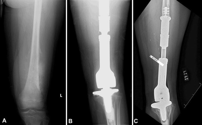 Review of Osteosarcoma and Current Management | SpringerLink