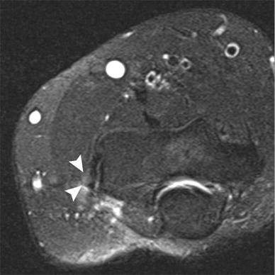 Clinical Examination, Ultrasound and MRI Imaging of The Painful Elbow ...