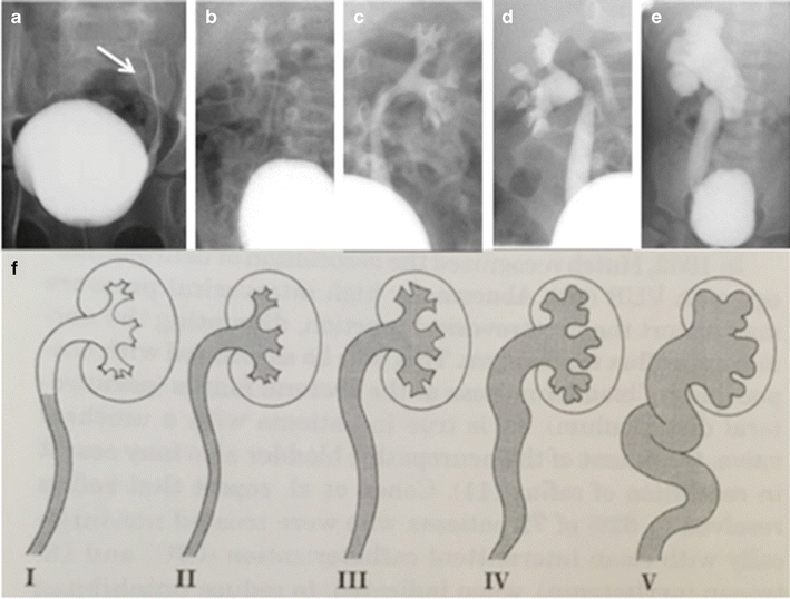 Managing Vesicoureteral Reflux in the Pediatric Patient: a Spectrum of ...