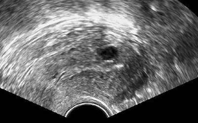 Adenomyose | SpringerLink