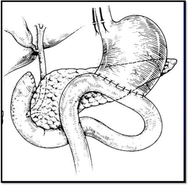 Traumatic Injury of the Duodenum and Pancreas: How to Approach a Rare ...