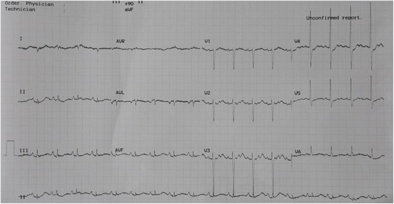 Subarachnoid Hemorrhage Mimicking ST Segment Elevation Myocardial ...