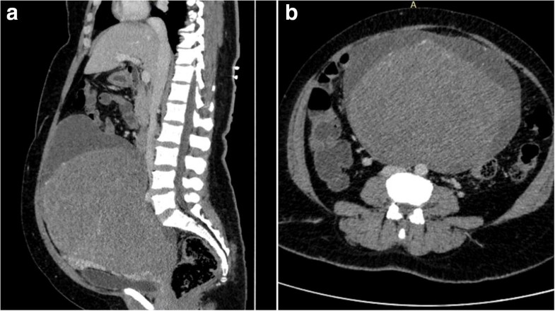 An Unusual Presentation of a Large Cervical Fibroid—Case Report ...